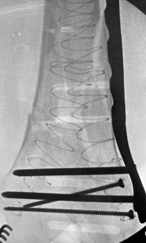 IlluminOss - Fracture Repair at the Speed of Light