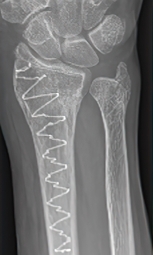 IlluminOss - Fracture Repair at the Speed of Light