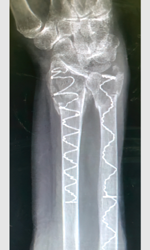 IlluminOss - Fracture Repair at the Speed of Light