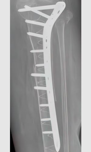 IlluminOss - Fracture Repair at the Speed of Light