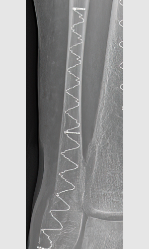 IlluminOss - Fracture Repair at the Speed of Light